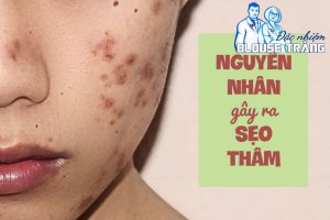 8 cách trị sẹo thâm hiệu quả nhất bằng phương pháp tự nhiên tại nhà